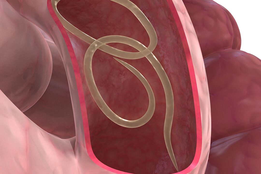 Vrste crva kod ljudi, infekcija, prevencija, liječenje - Wormin